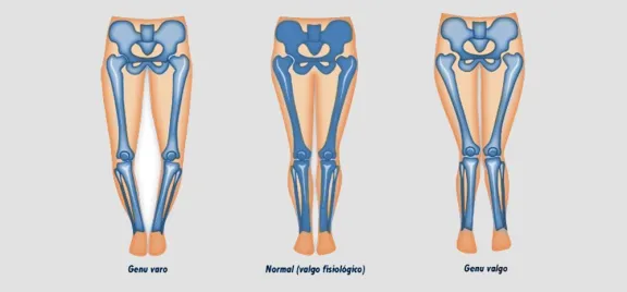 Genu valgo, la enfermedad que deforma las rodillas comienza en la ...